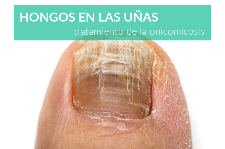 Hongos en las uñas: tratamiento – ServicioFarma Blog